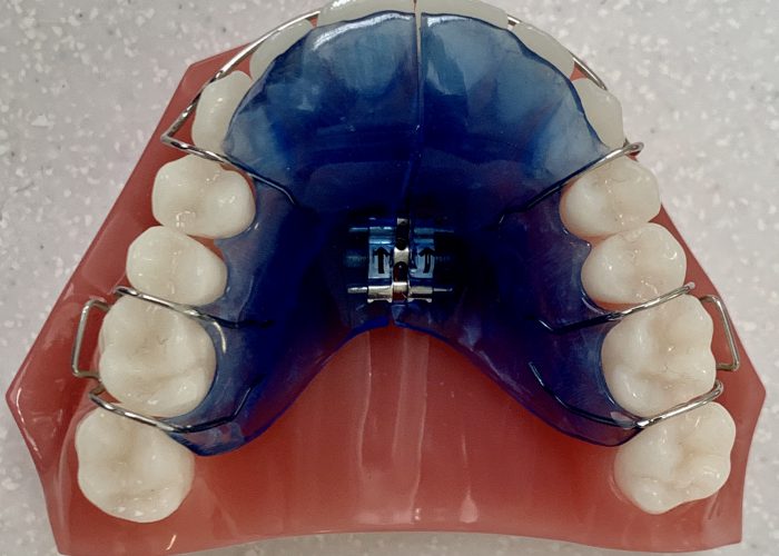 Orthodontiepraktijk Leeuwarden Welke beugel? - Orthodontiepraktijk ...